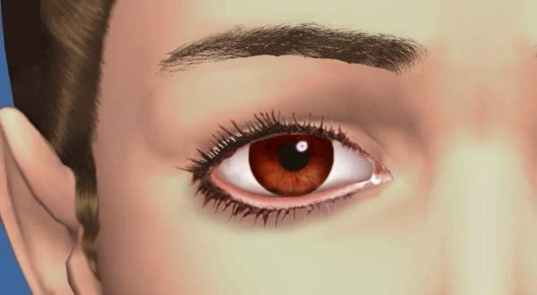 04-Ectropion | Eye Physicians and Surgeons of Ontario