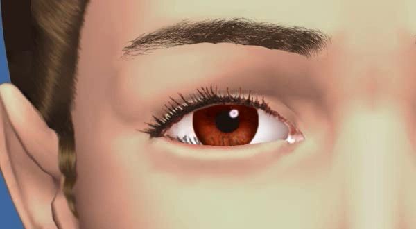 05-Entropion | Eye Physicians and Surgeons of Ontario