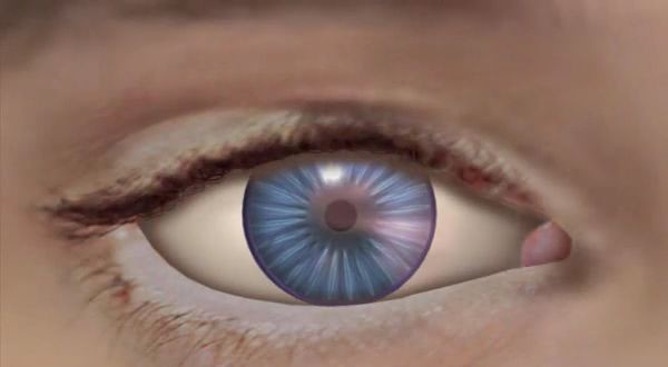 08-Trabeculectomy | Eye Physicians and Surgeons of Ontario