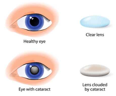 Cataract Surgery in Ontario | Eye Physicians and Surgeons of Ontario